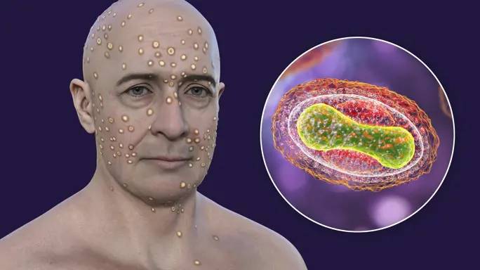 More than 18,700 mpox cases detected in Africa since January: Health agency